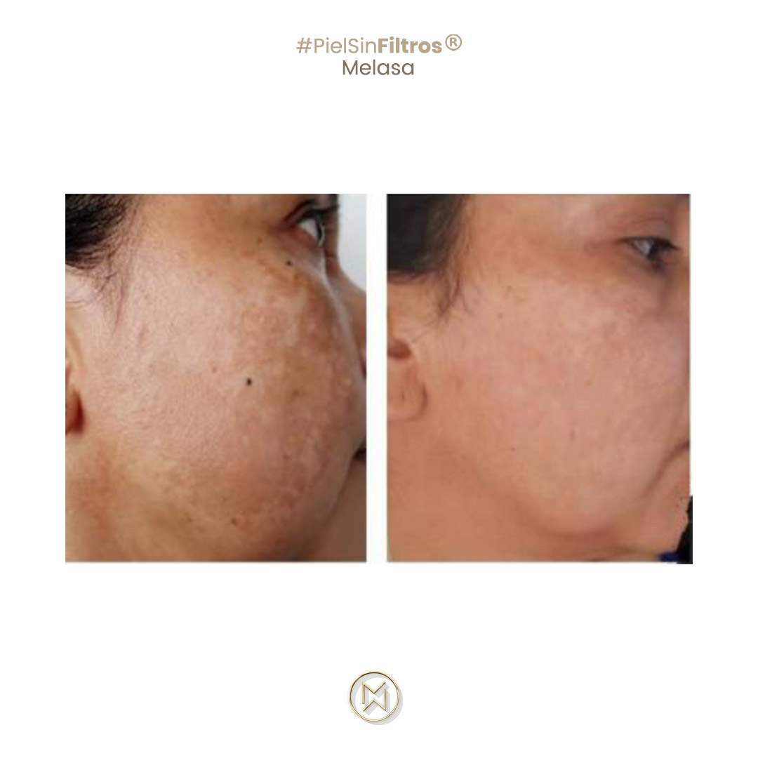 Antes y Despues – Skincare dermocosmetica